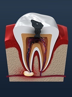 Root Canal Therapy | Topeka Endodontics | Michel Dental